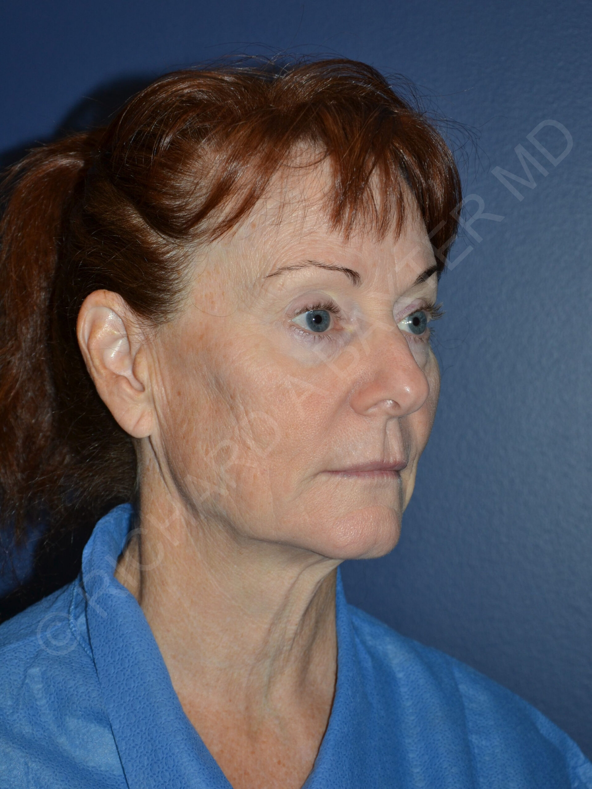 Facelift/Neck Lift Before & After Gallery Case 10527 - Phase Plastic ...